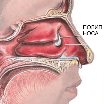 Полипы носа (полипоз) - причины появления, симптомы и методы лечения